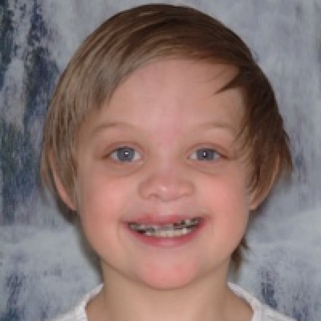 Teinar: Hare lip and cleft gum